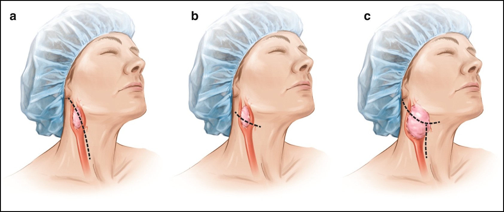 Carotid Body Cancer – Familial carotid body tumors: case report and ...