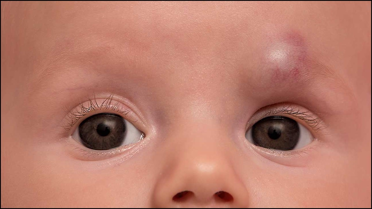 Best Doctor for Hemangioma treatment in India