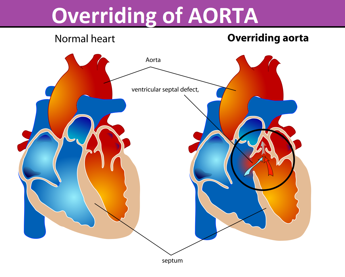 Tetralogy of Fallot defects correction surgery in India , Best ...