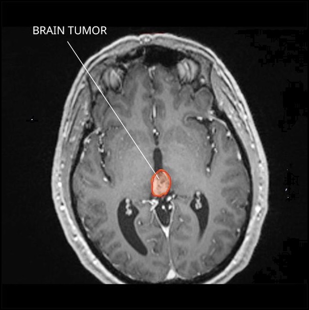 Pineal gland tumor